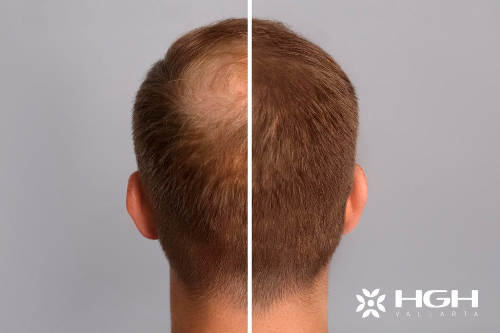 HGH Before And After: Transform Your Health | HGH Vallarta